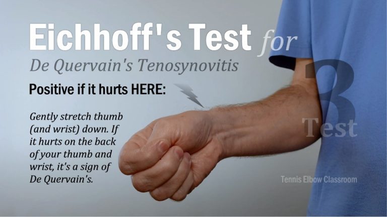 3 Quick Tests for De Quervain's / Mommy Thumb – Diagnose Yourself